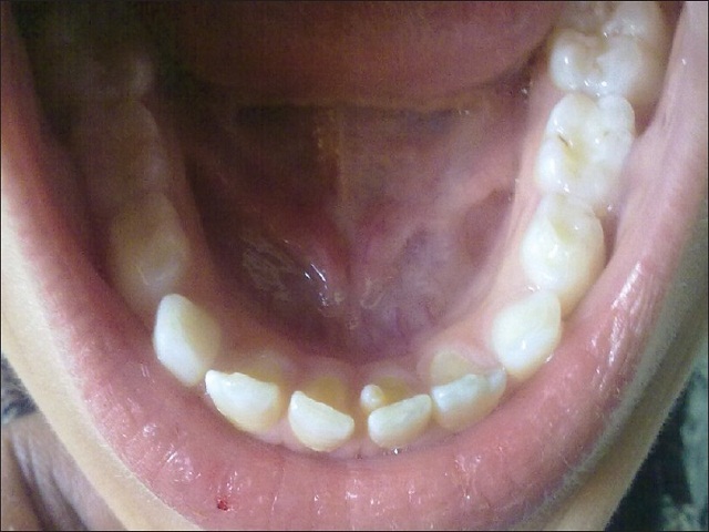 Mandibular talon cusp: A rare presentation with the literature review ...
