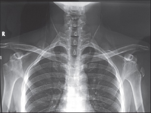 Bilateral anterior shoulder dislocation – Journal of Natural Science ...