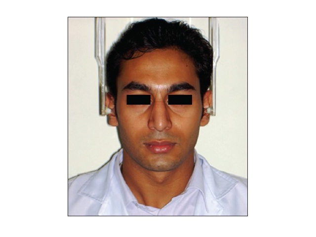 A cross-sectional clinical study on shape of nose inner-canthal ...