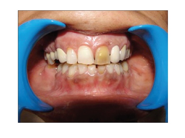 Bleaching of a non-vital anterior tooth to remove the intrinsic ...