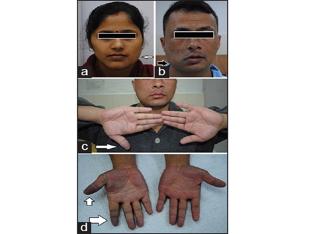 Monostotic fibrous dysplasia with Raynaud’s phenomenon – Journal of ...