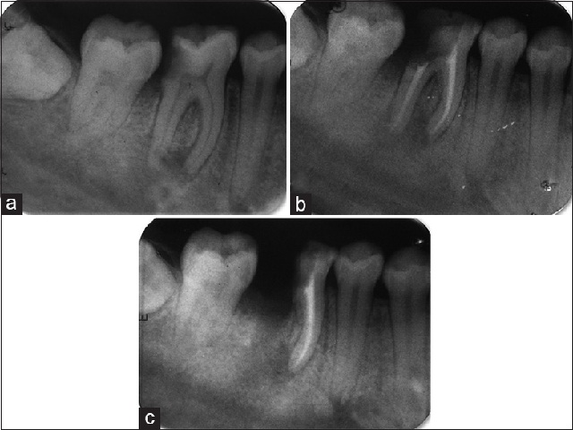 Hemisection as a conservative management of grossly carious permanent ...