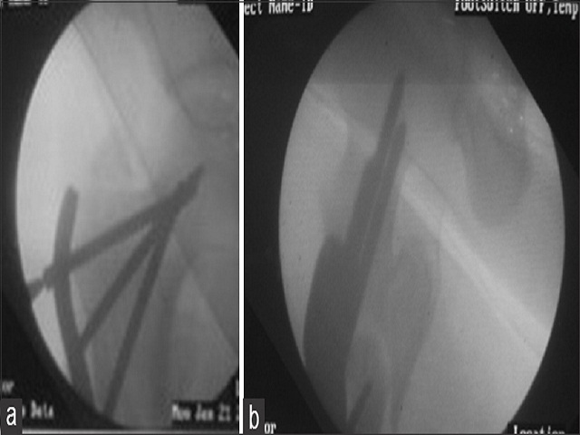 Dynamic hip screw versus proximal femur locking compression plate in ...